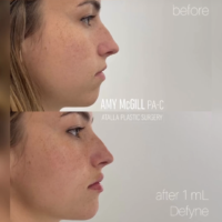 Atalla Plastic Surgery / Master Injectors BOTOX® + FILLERS-Bowling Green KY