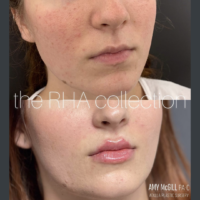 Atalla Plastic Surgery / Master Injectors BOTOX® + FILLERS-Bowling Green KY